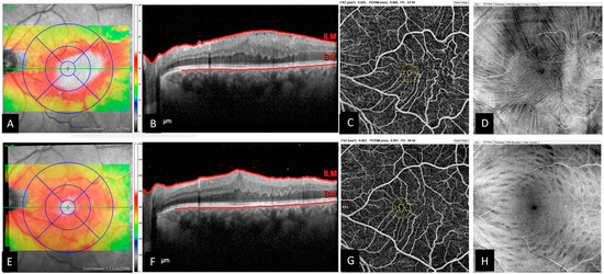 Retinal Vascular Tortuosity Index Change after Idiopathic Epiretinal ...