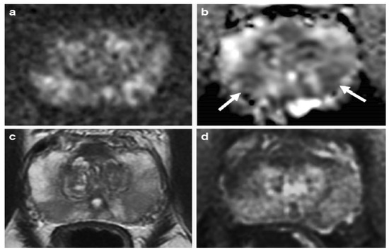 Diagnostic Performance Evaluation of Multiparametric Magnetic Resonance Imaging in the Detection ...
