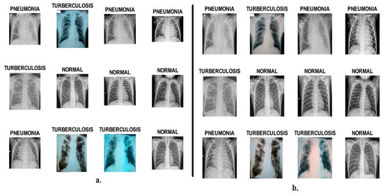 Multi-Techniques for Analyzing X-ray Images for Early Detection and ...