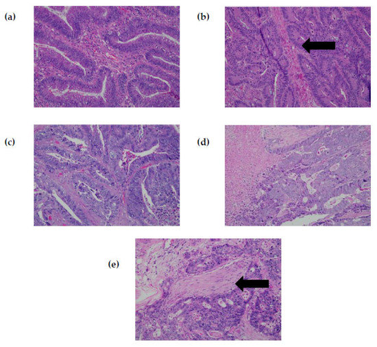 KRAS Mutational Profiles among Colorectal Cancer Patients in the East ...