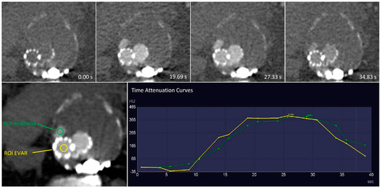Dynamic Computed Tomography Angiography as Imaging Method for Endoleak ...