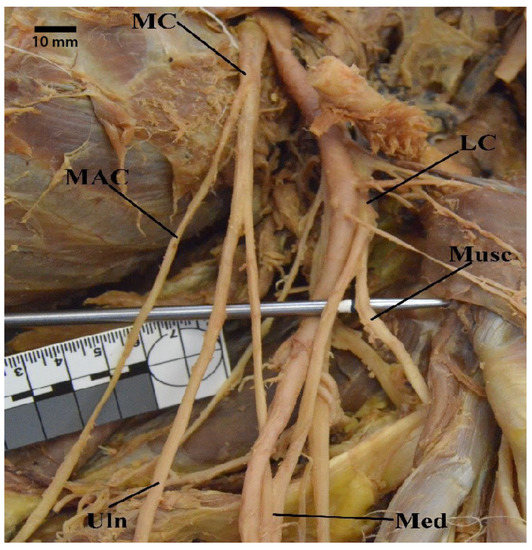 Clinically Relevant Anatomical Variations in the Brachial Plexus
