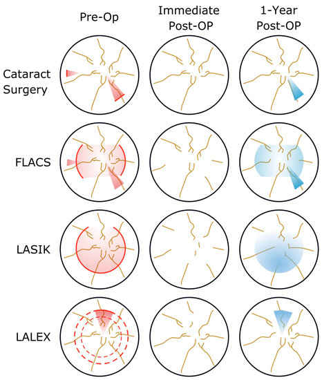 Solving STODS—Surgical Temporary Ocular Discomfort Syndrome