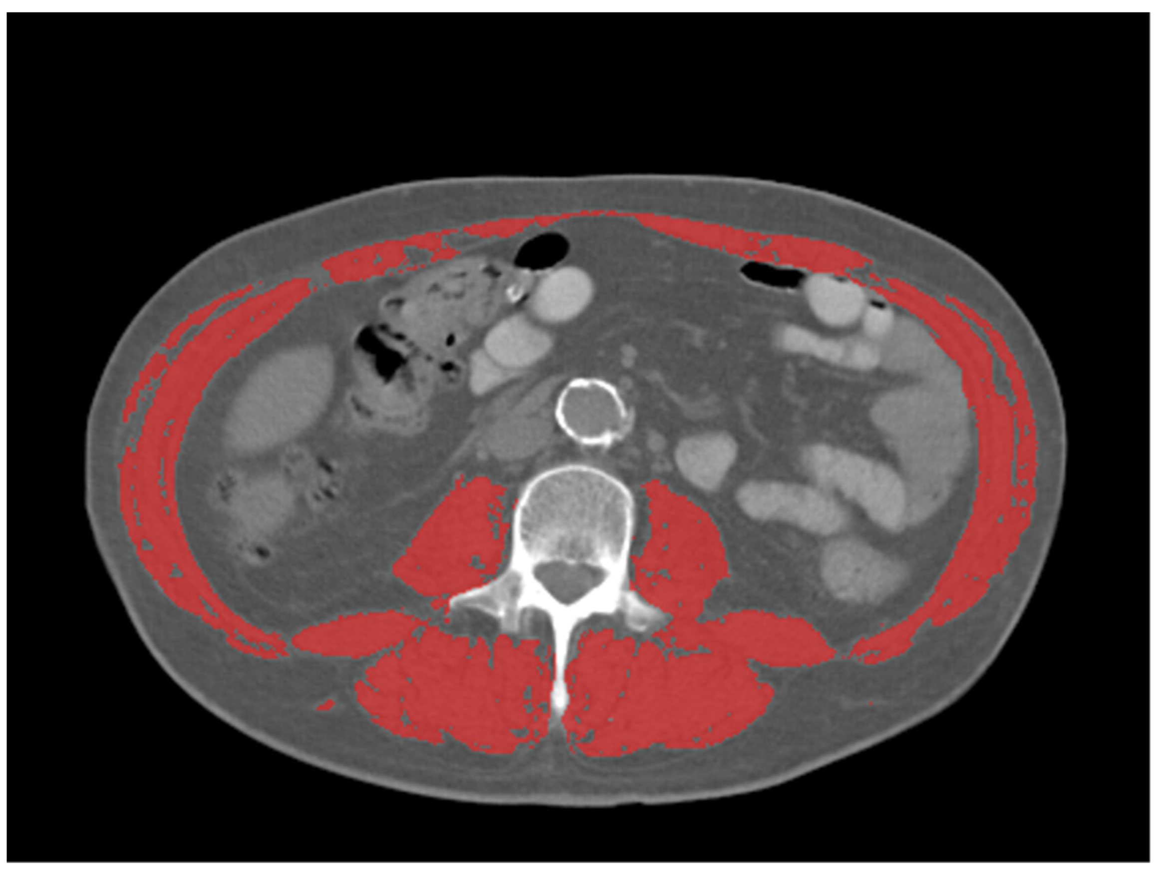 Prognostic Value of Sarcopenia and Metabolic Parameters of 18F-FDG-PET ...