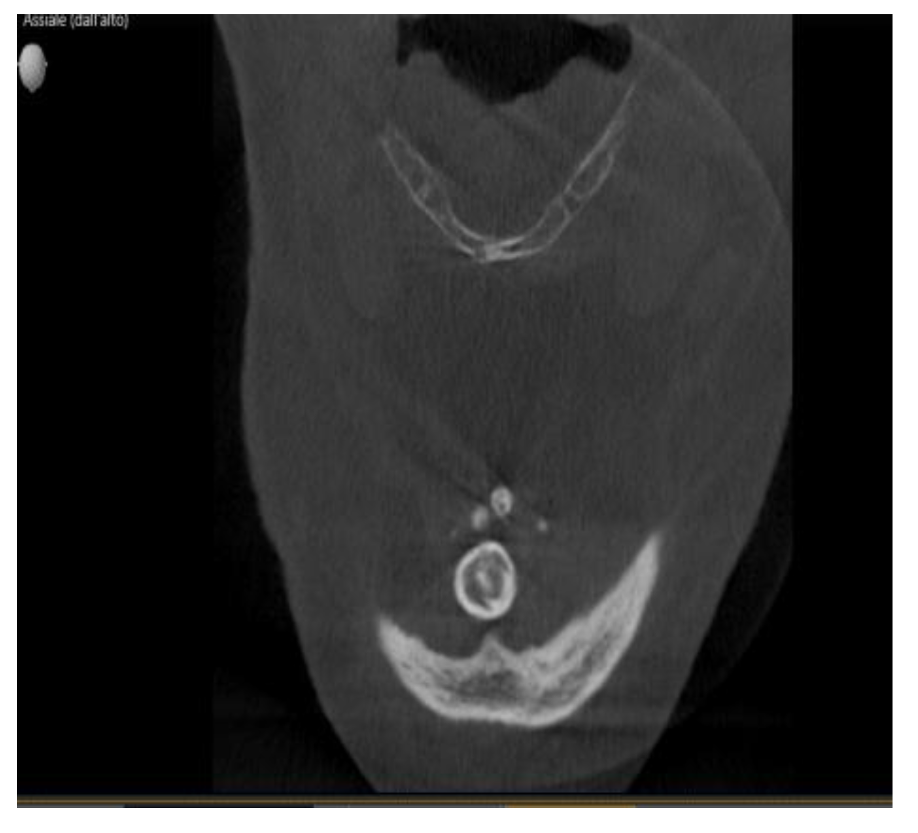 Enigmatic Formations Found in Routine Orthopantomography (OPG) Examinations: A Case Report