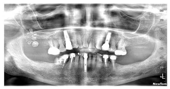 Enigmatic Formations Found in Routine Orthopantomography (OPG ...