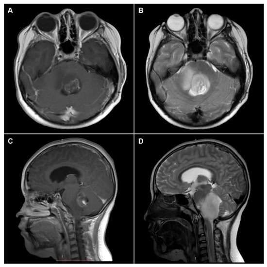 Diagnostic Performance of Selected MRI-Derived Radiomics Able to ...