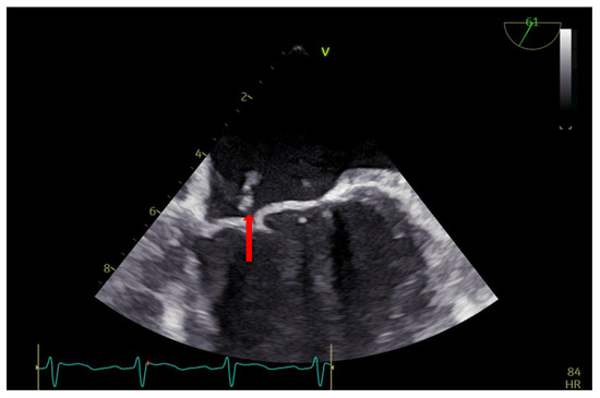 Surgical Atrial Septal Patch Endocarditis in a Patient with a Complete ...