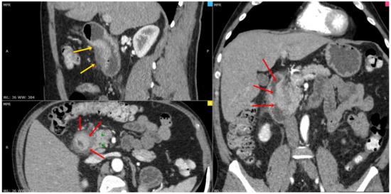 Diagnostics | Free Full-Text | Groove Pancreatitis—Tumor-like Lesion of ...
