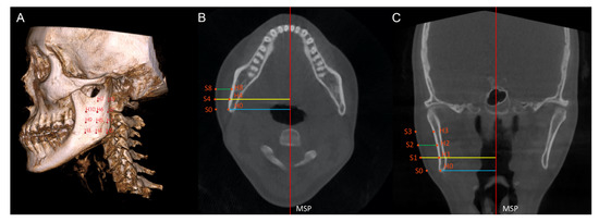 Hard and Soft Tissue Asymmetry in Patients with Skeletal Class III ...