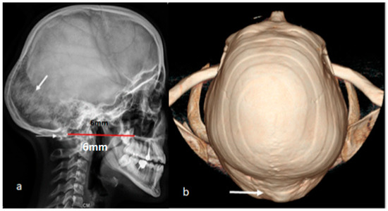 The Tomographic Study and the Phenotype of Wormian Bones