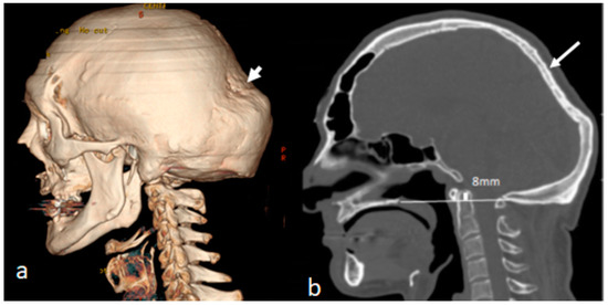 The Tomographic Study and the Phenotype of Wormian Bones
