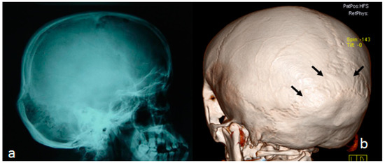 The Tomographic Study and the Phenotype of Wormian Bones