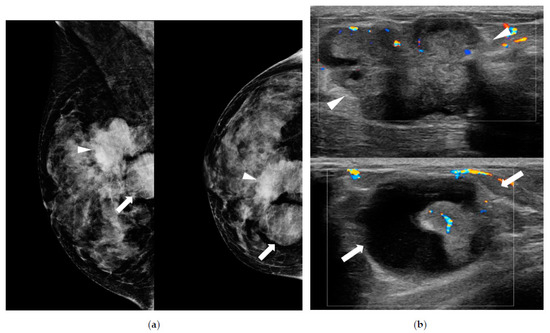 Clinicopathological and Imaging Features of Breast Papillary Lesions ...