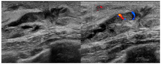 Clinicopathological and Imaging Features of Breast Papillary Lesions ...