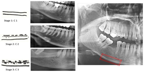 Osteoporosis Screening Using Dental Panoramic Radiographs and Age at Menarche
