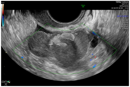 Performance of IOTA Simple Rules Risks, ADNEX Model, Subjective Assessment Compared to CA125 and ...