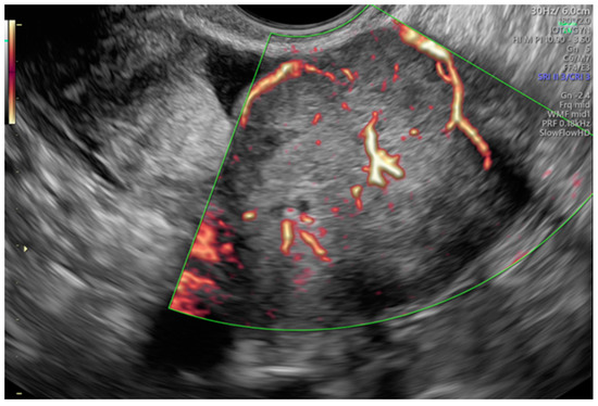Performance of IOTA Simple Rules Risks, ADNEX Model, Subjective ...