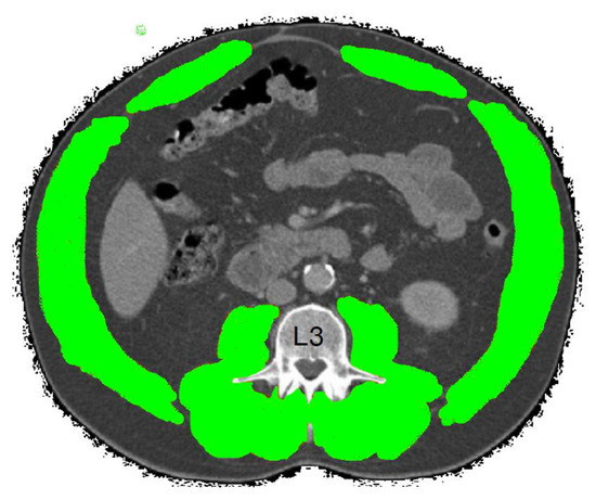 Update on Lean Body Mass Diagnostic Assessment in Critical Illness