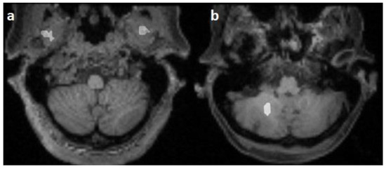 Prediction of the Topography of the Corticospinal Tract on T1-Weighted ...