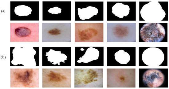 A Collaborative Learning Model for Skin Lesion Segmentation and ...