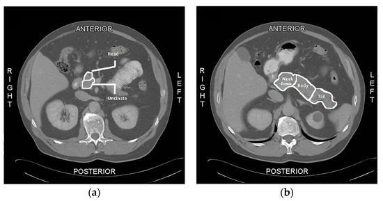 Can Imaging Using Radiomics and Fat Fraction Analysis Detect Early ...