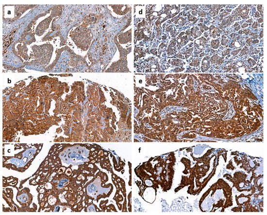 Chemerin and Chemokine-like Receptor 1 Expression in Ovarian Cancer ...