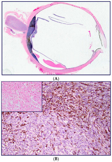Interpreting Discordant Monosomy 3 FISH and Chromosomal Microarray ...