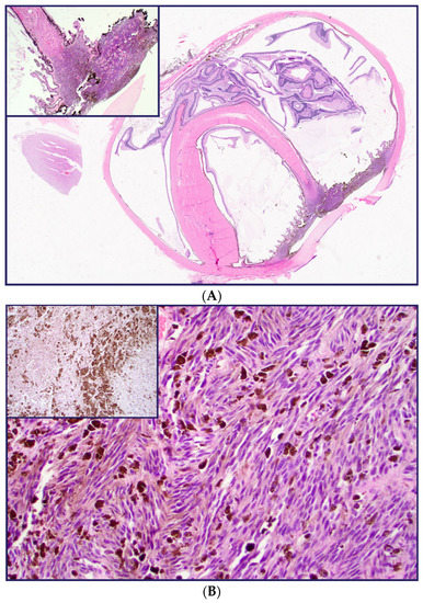 Interpreting Discordant Monosomy 3 FISH and Chromosomal Microarray ...