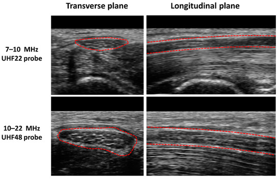 Quantitative Ultrasound Techniques Used for Peripheral Nerve Assessment