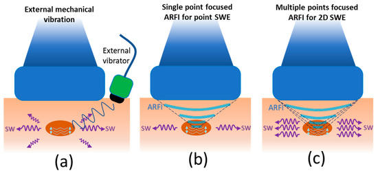 Quantitative Ultrasound Techniques Used for Peripheral Nerve Assessment