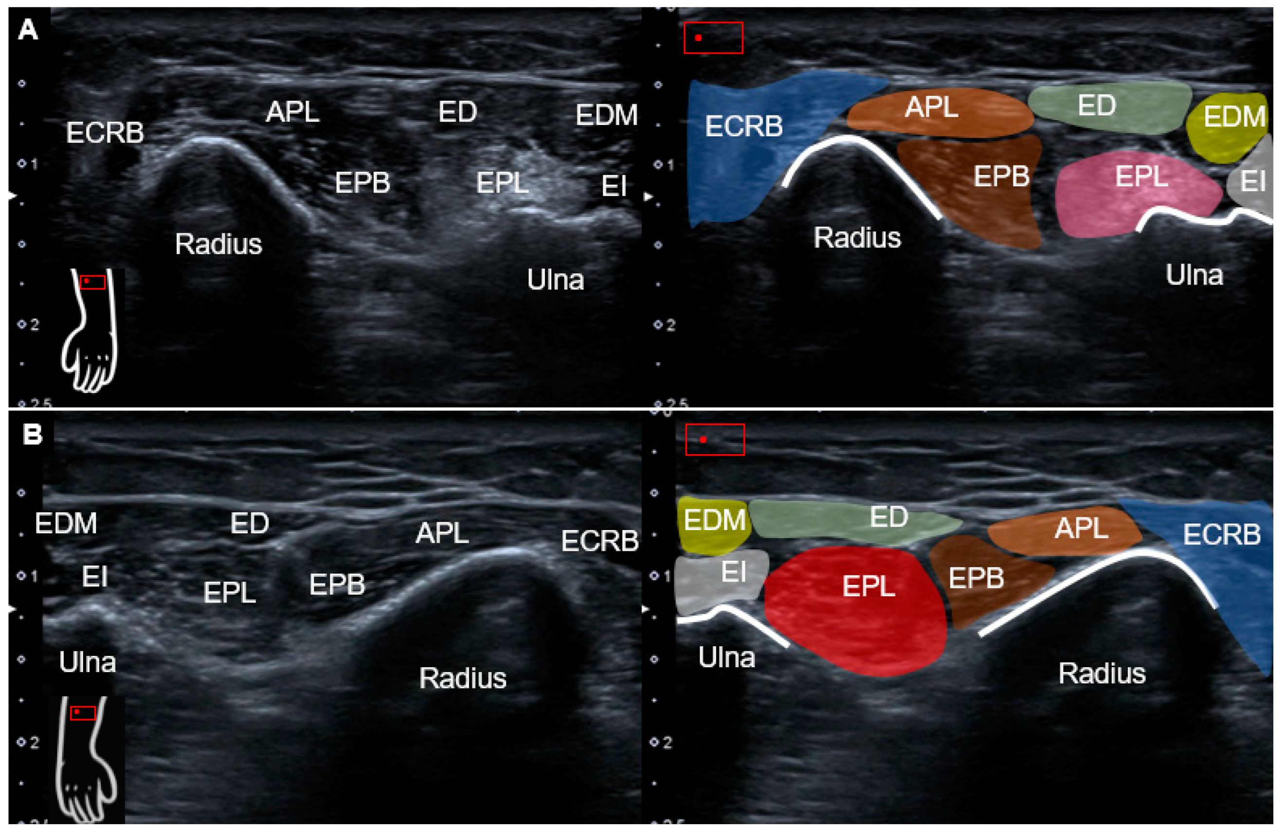 Dynamic Ultrasound Examination for Extensor Pollicis Longus Tendon Rupture after Palpation ...