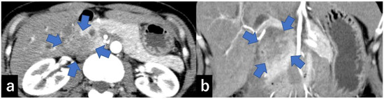 Clinical Features and Prognostic Impact of Pancreatic Ductal ...