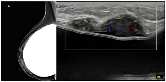 Recent Advances in Ultrasound Breast Imaging: From Industry to Clinical ...