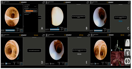 Advanced Imaging for Robotic Bronchoscopy: A Review