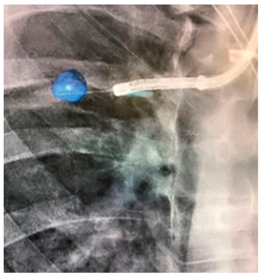 Advanced Imaging for Robotic Bronchoscopy: A Review