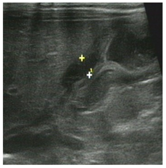Ultrasonic Diagnosis of Intestinal Obstruction in Neonates-Original Article