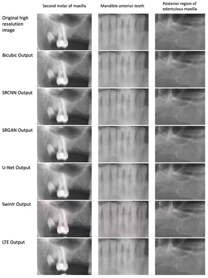 Super-Resolution of Dental Panoramic Radiographs Using Deep Learning: A Pilot Study