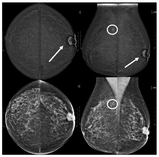 Diagnostics | Free Full-Text | Contrast Enhanced Mammography (CEM) Enhancing Asymmetry: Single ...