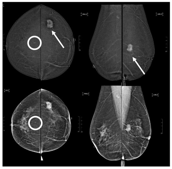Contrast Enhanced Mammography (CEM) Enhancing Asymmetry: Single-Center ...