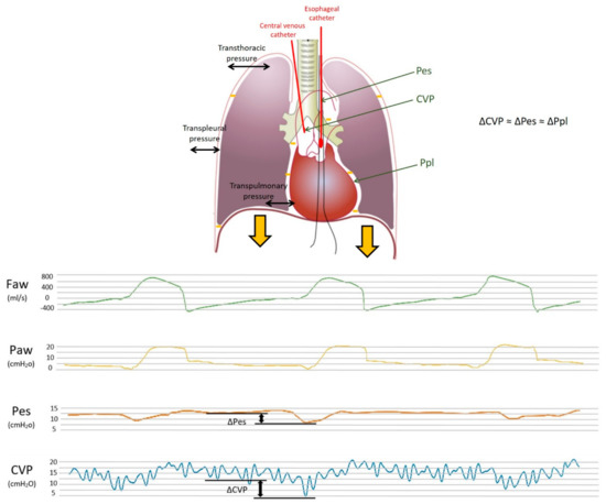 Respiratory Variations of Central Venous Pressure as Indices of Pleural ...