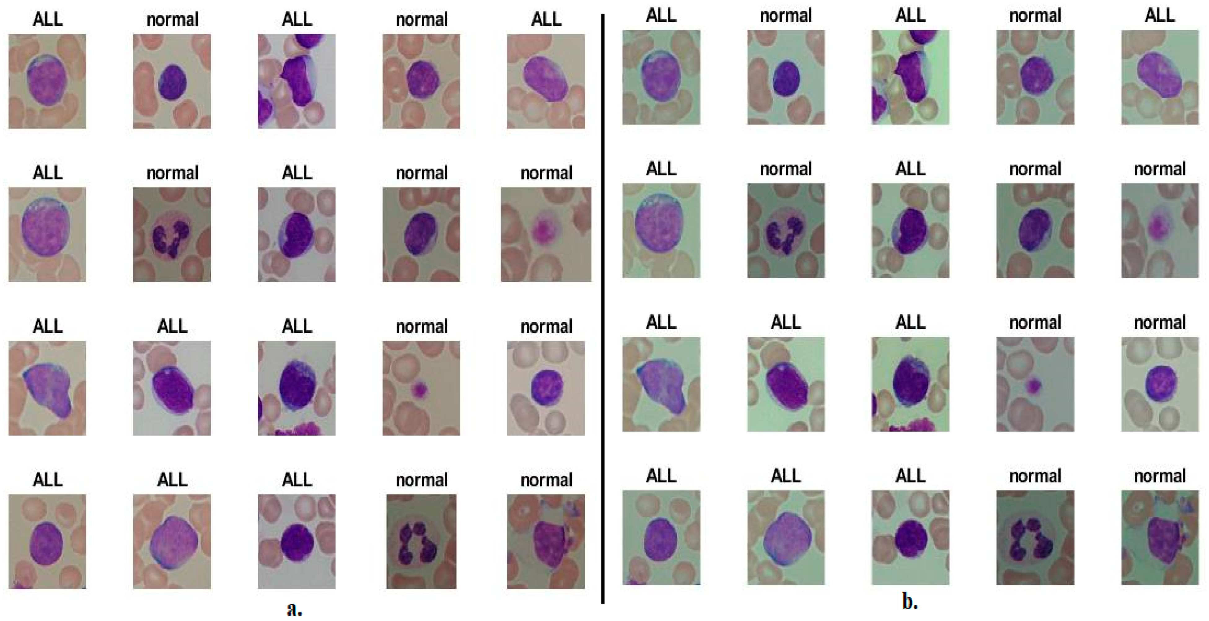 Diagnostics | Free Full-Text | Hybrid Techniques for the Diagnosis of Acute Lymphoblastic ...