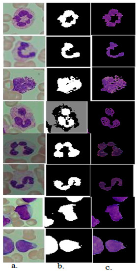 Diagnostics | Free Full-Text | Hybrid Techniques for the Diagnosis of Acute Lymphoblastic ...
