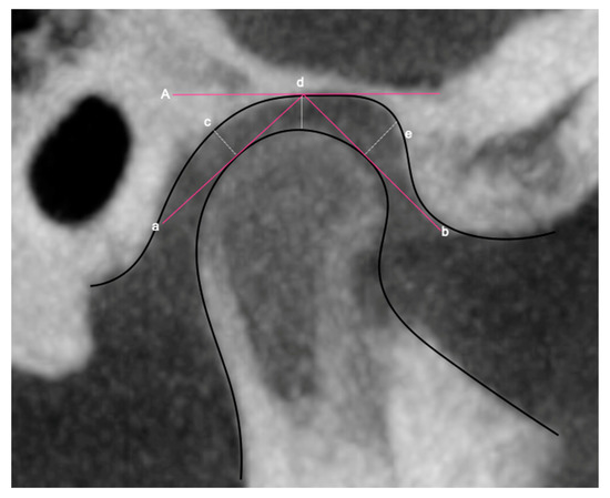 Positional Features of the Mandibular Condyle in Patients with Facial ...