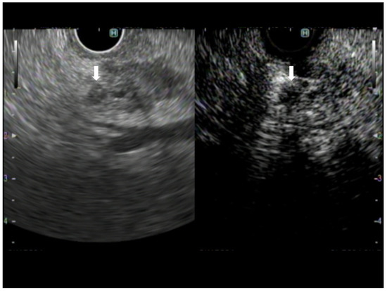 Contrast-Enhanced Harmonic Endoscopic Ultrasound-Guided Puncture for ...
