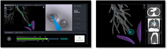 The Use of Robotic-Assisted Bronchoscopy in the Diagnostic Evaluation ...