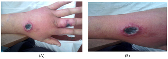 Human Anthrax: Update of the Diagnosis and Treatment