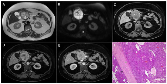 The Role of MRI in the Diagnosis of Solid Pseudopapillary Neoplasm of ...
