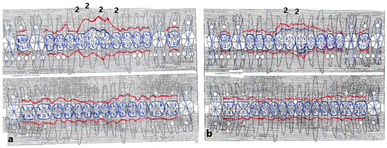 Clinical Aspects and Therapeutic Management of an Aggressive ...