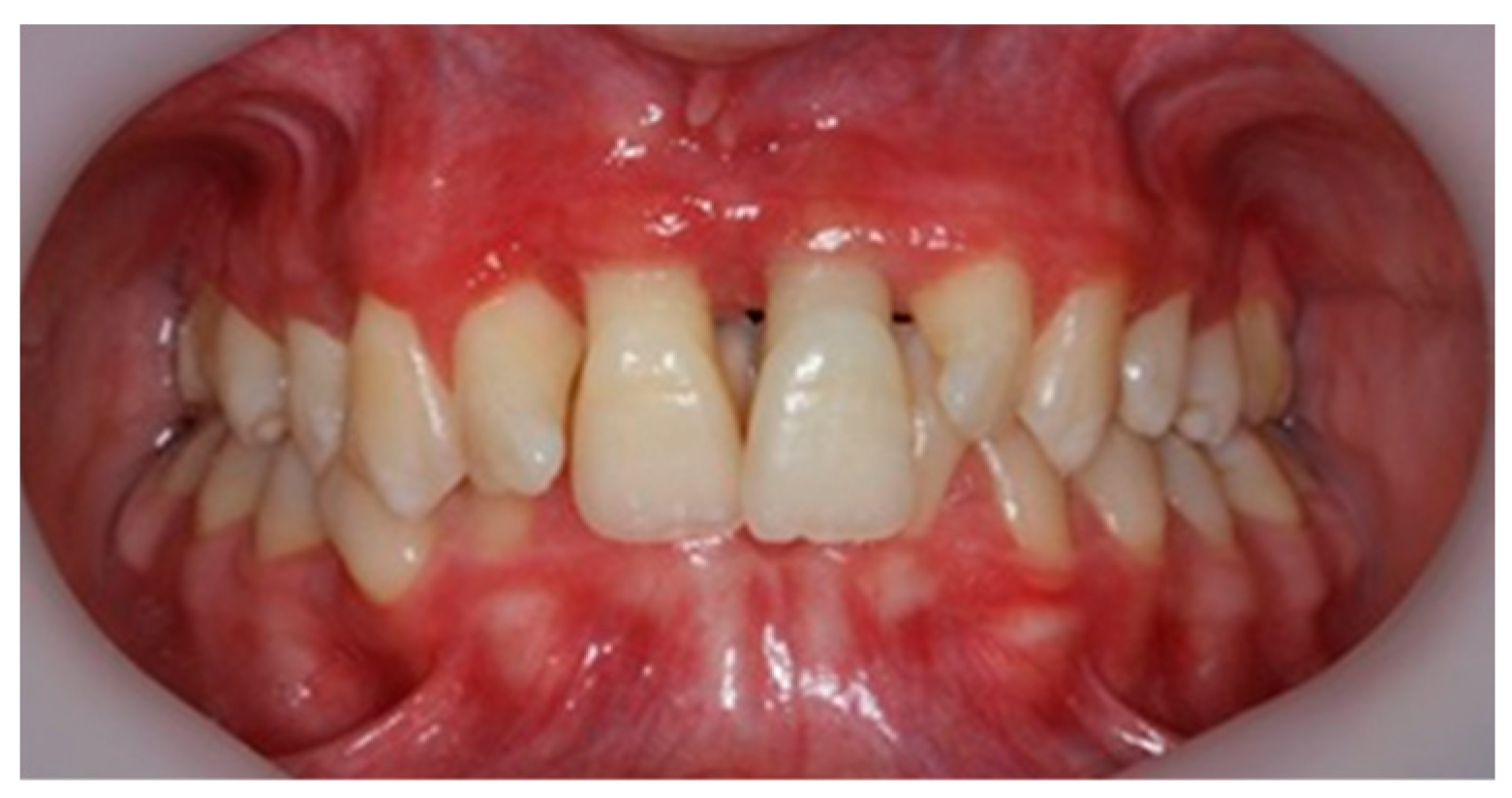 Clinical Aspects and Therapeutic Management of an Aggressive ...